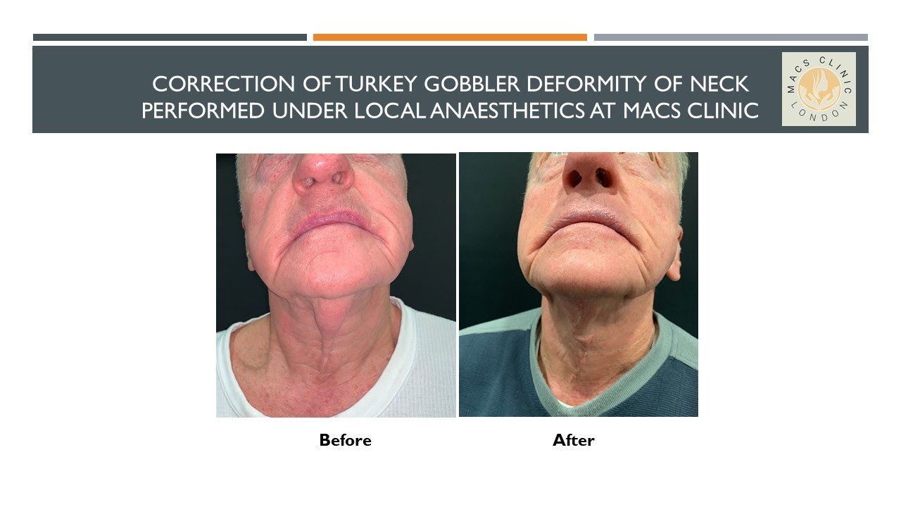 Correction of Turkey Gobbler Deformity of neck performed under local ...