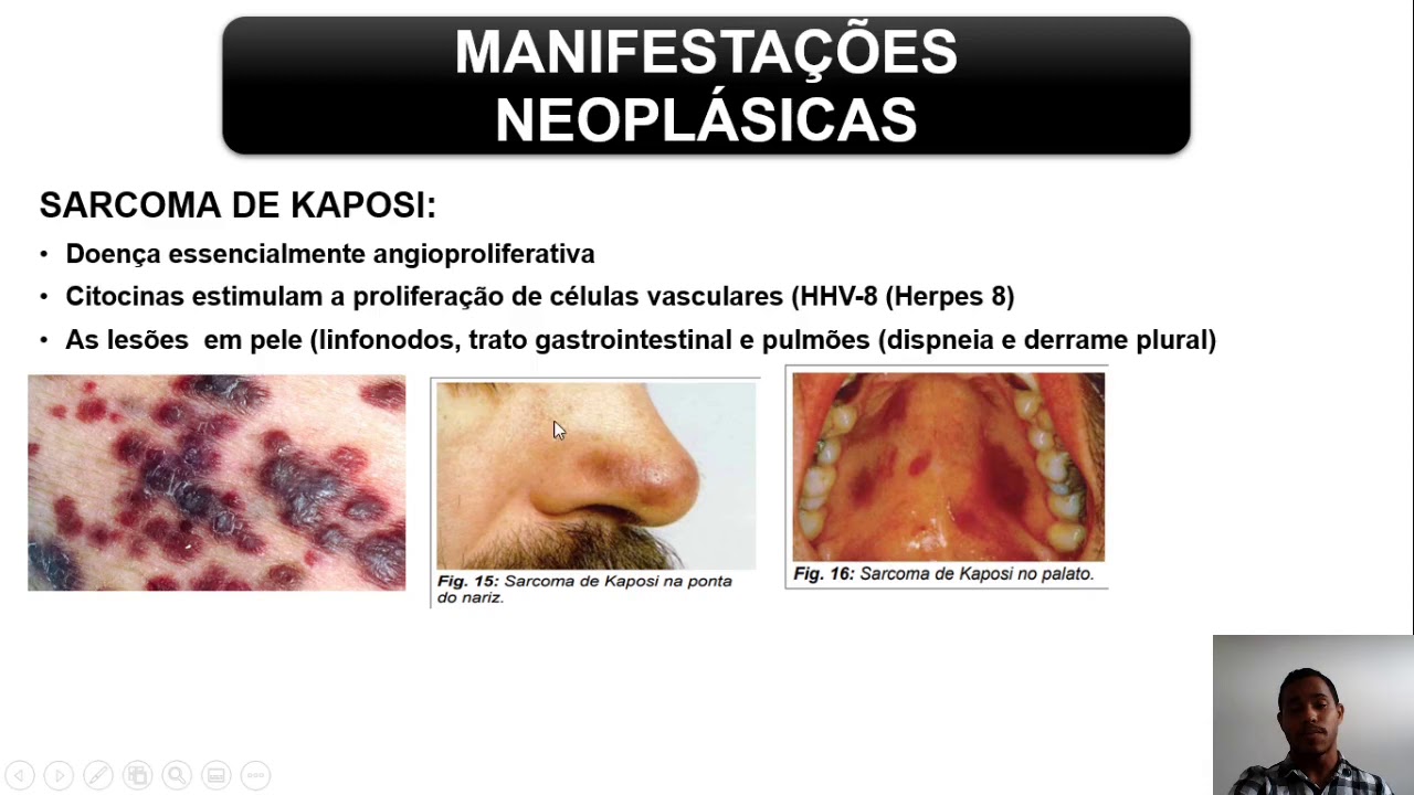 HIV/AIDS PARTE 2 - YouTube