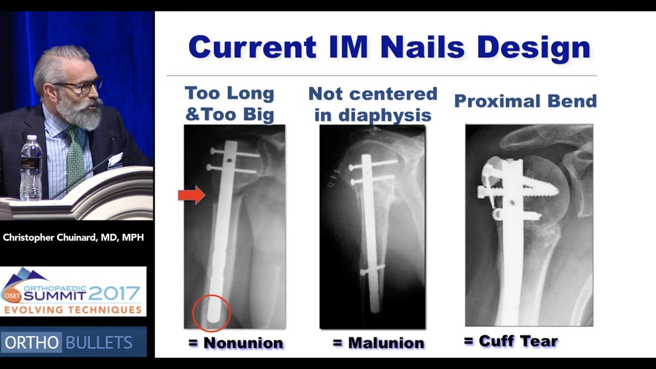 Pro: Humeral Nail: I Can Make It Come Together - No Sweat ...