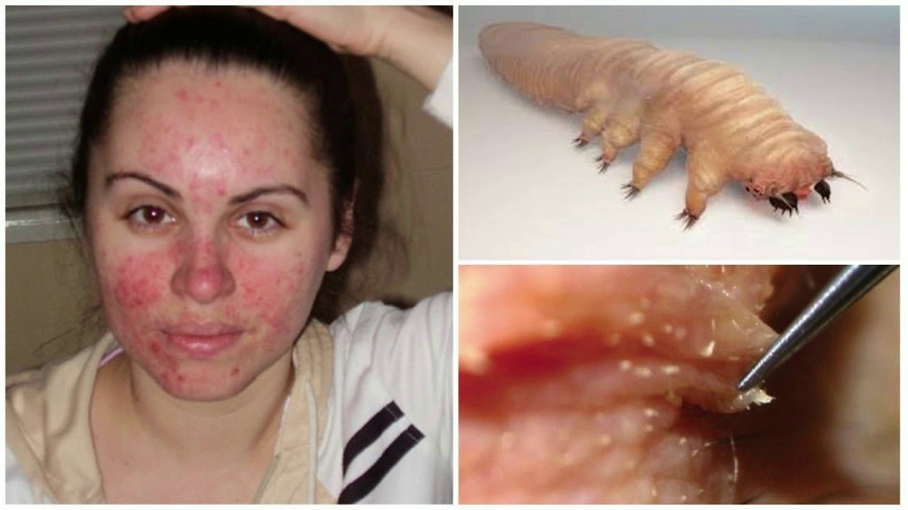 Demodicosis - YouTube