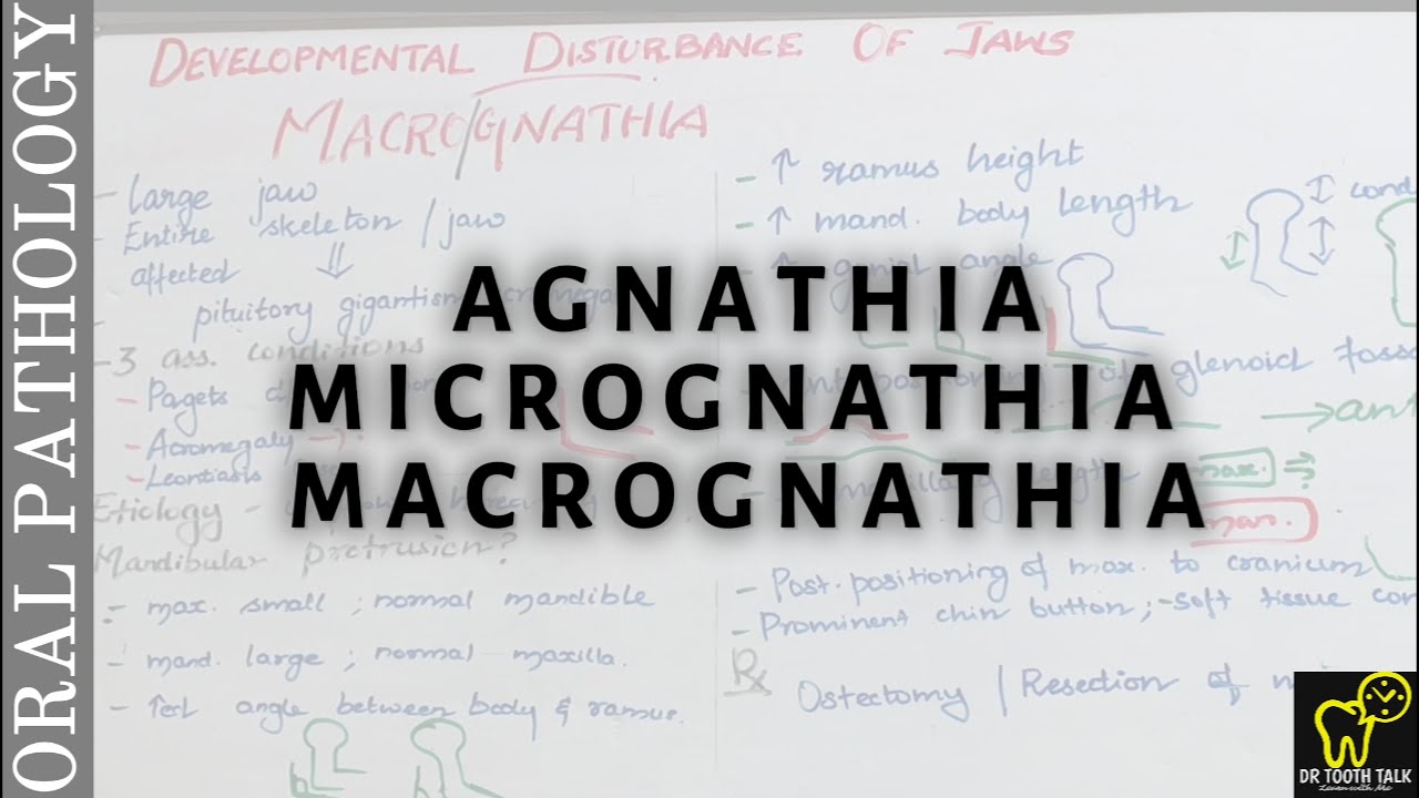 Agnathia, Micrognathia and Macrognathia | Developmental Disturbances Of ...
