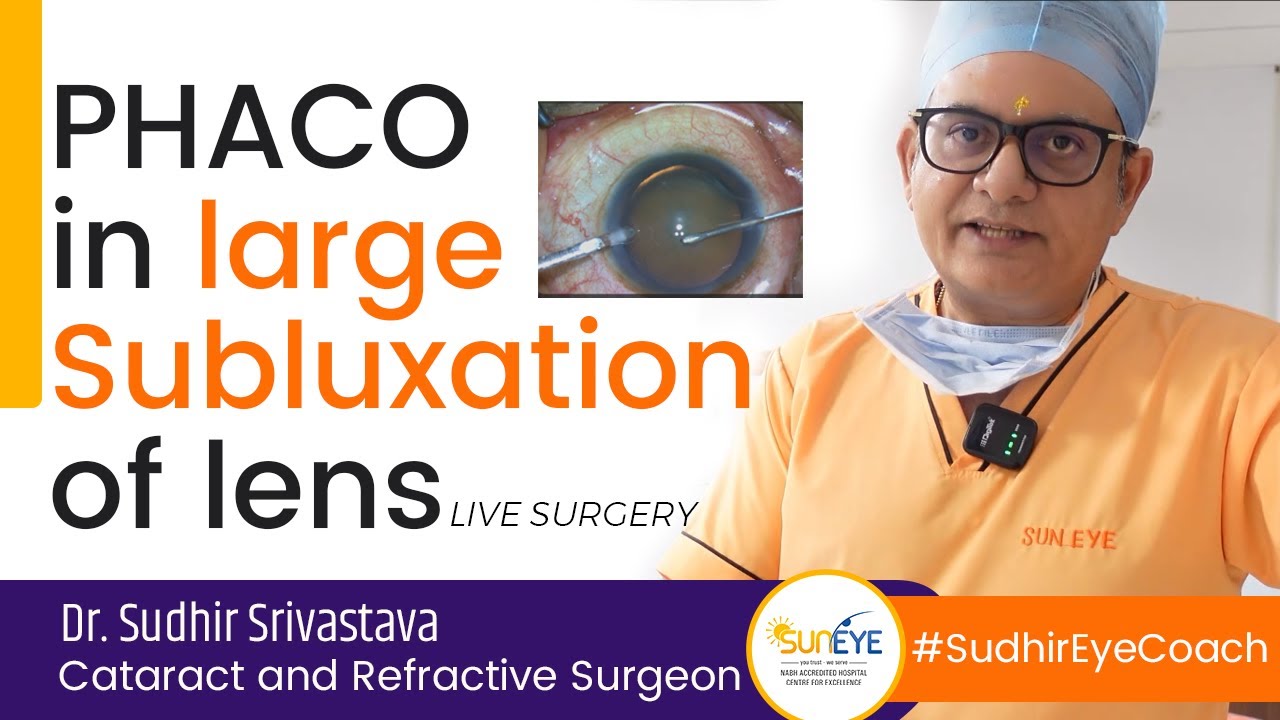 Phaco surgery in subluxation of lens I Subluxated cataract surgery I ...