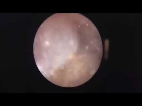 Dr Seymur Mehtiyev Uroloq Androloq - Böyrək daşı əməliyyatı