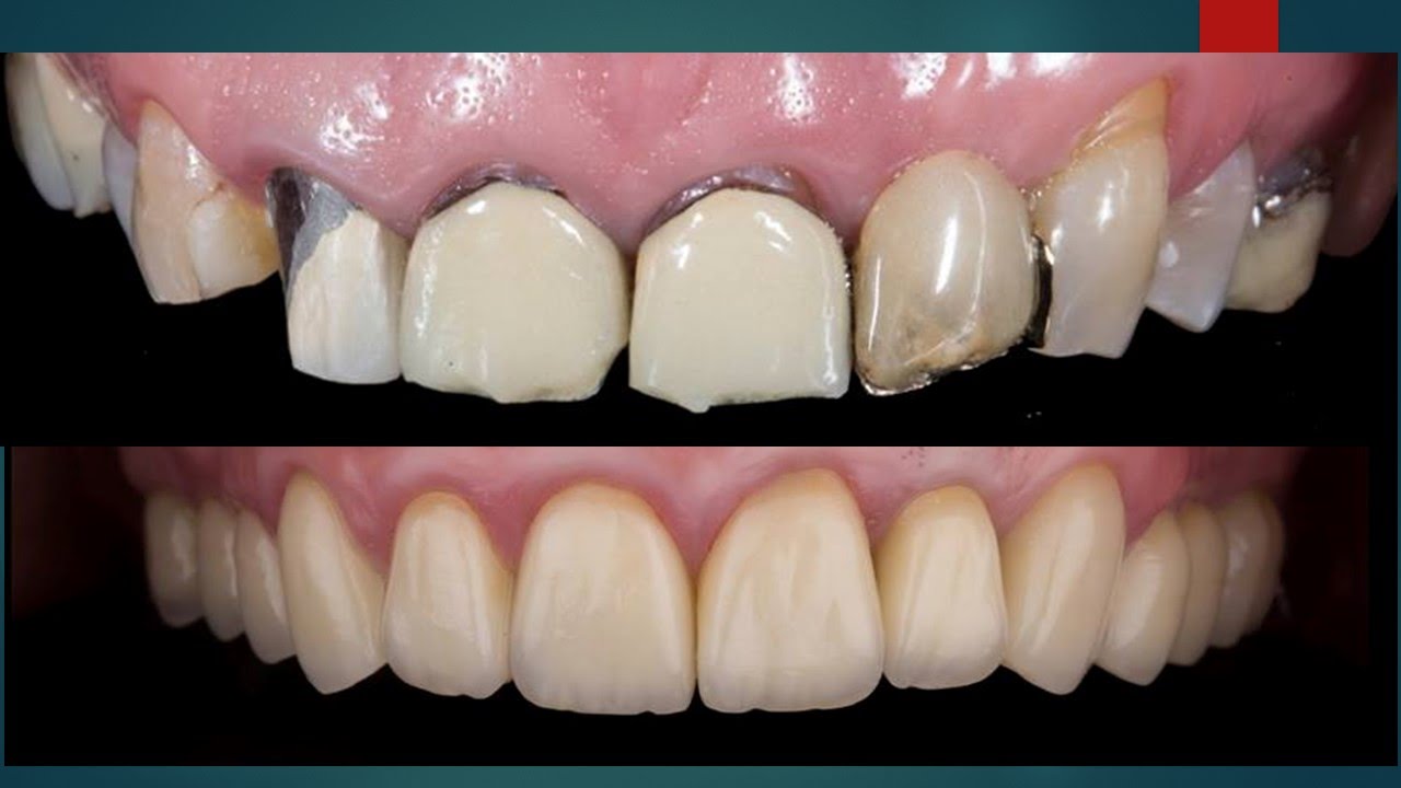 Amazing dental Veneers by Dentist - YouTube