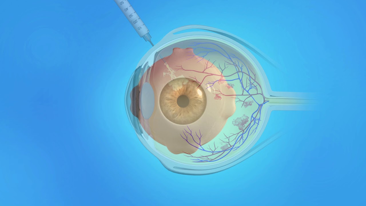 US Ophthalmic CRVO Injection - YouTube