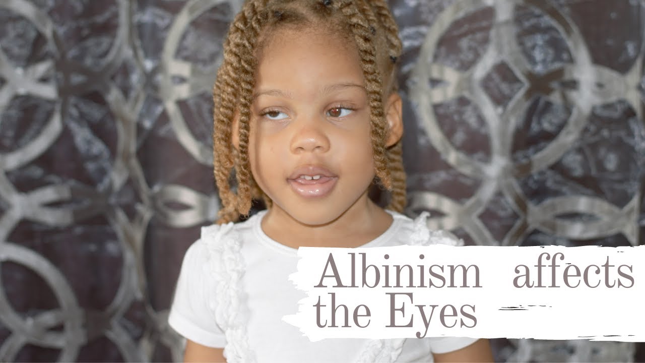 Common Eye Problems Found in Persons with Albinism - YouTube