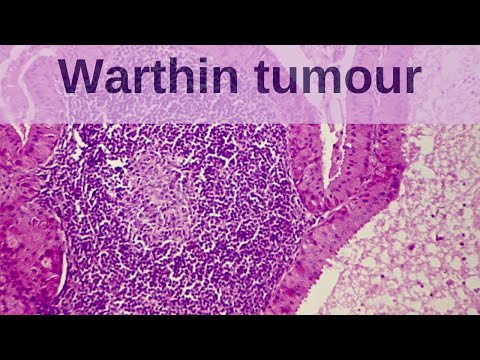 Warthin Tumour - Pathology mini tutorial - YouTube