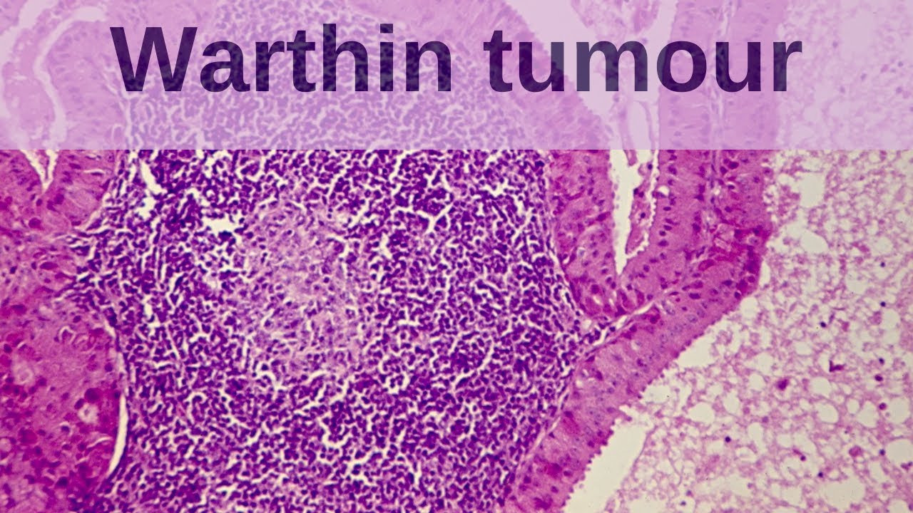 Warthin Tumour - Pathology mini tutorial - YouTube