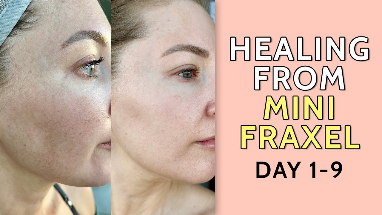 Healing from a Mini Fraxel Day 1-9 - YouTube