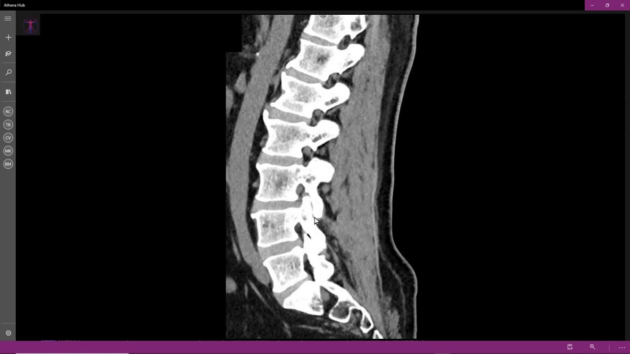 Hérnia discal foraminal (CT) - YouTube