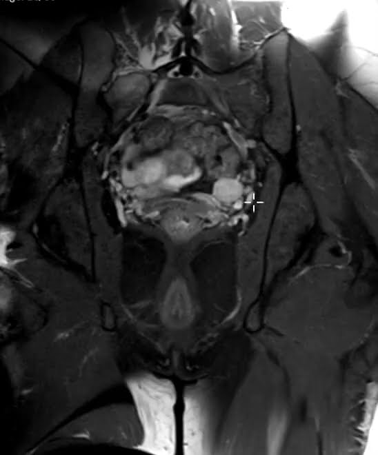 Ruptured ovarian cyst causing left hip pain - YouTube