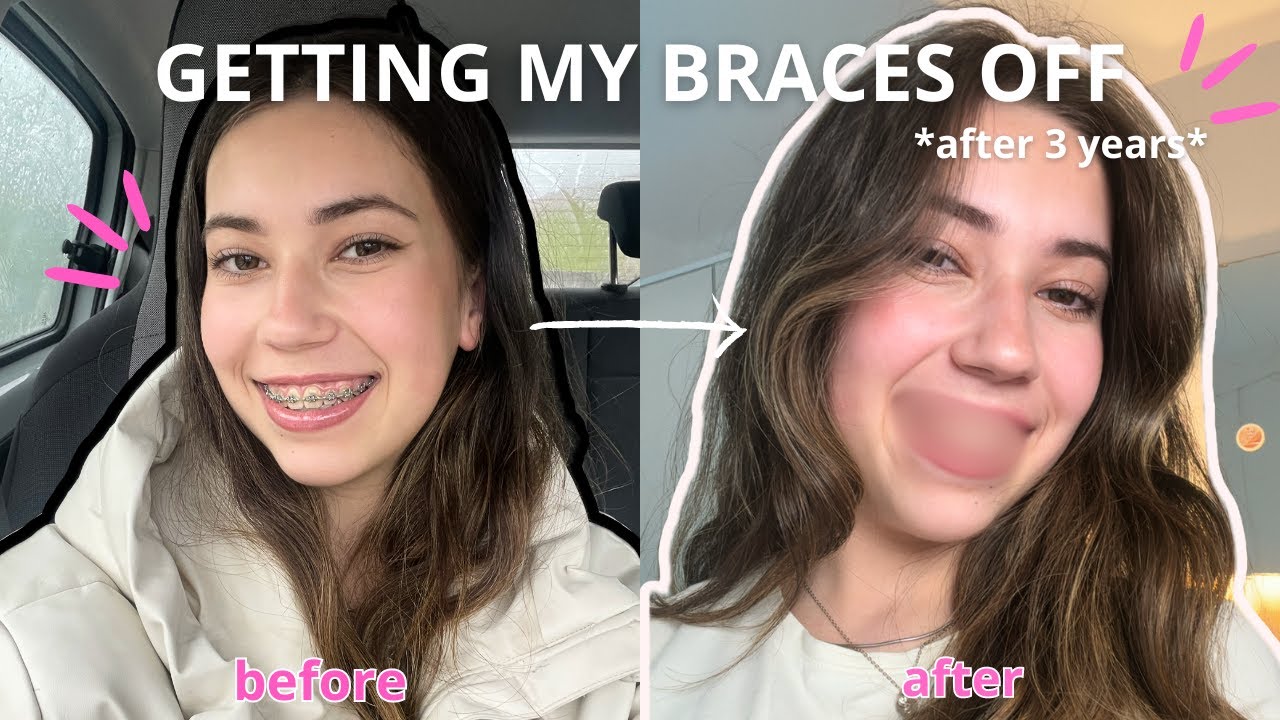 GETTING MY BRACES OFF *transformation* - YouTube