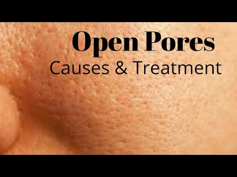 Open Pores causes and treatment by Dr. Manoj Das - YouTube
