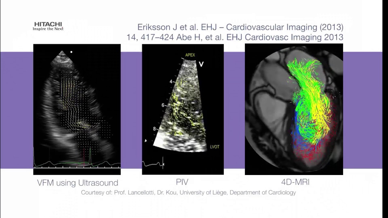 Hitachi's Vector Flow Mapping (VFM) - YouTube