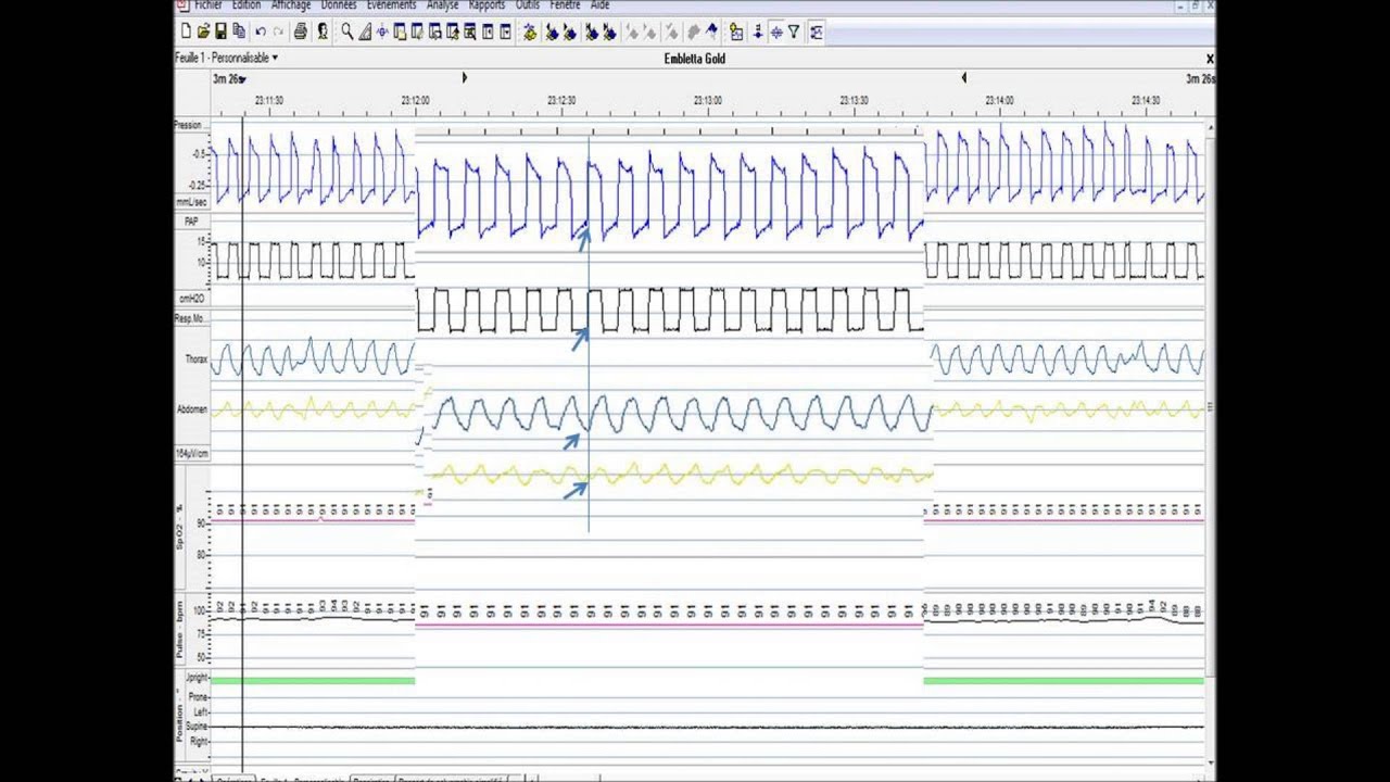 N°6 Généralités sur la polygraphie sous VNI - YouTube