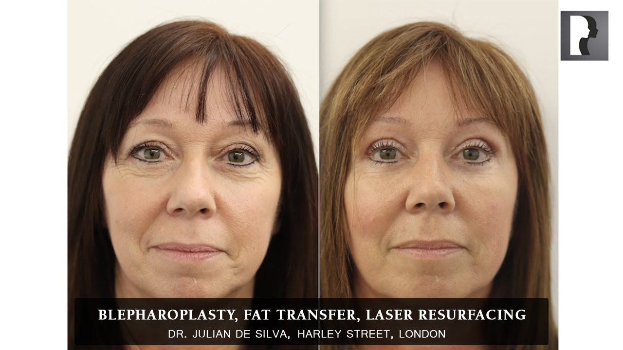 Blepharoplasty, My new fresh look and recovery process -Week4 - YouTube