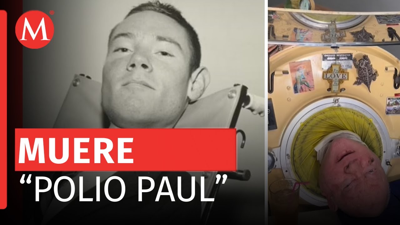 Fallece Paul Alexander, sobreviviente de la polio que vivió 70 años en ...