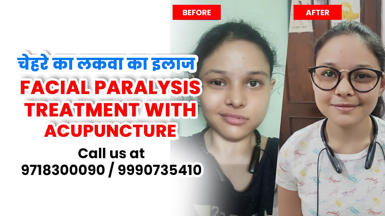 Facial paralysis treatment with acupuncture | Bells palsy treatment ...