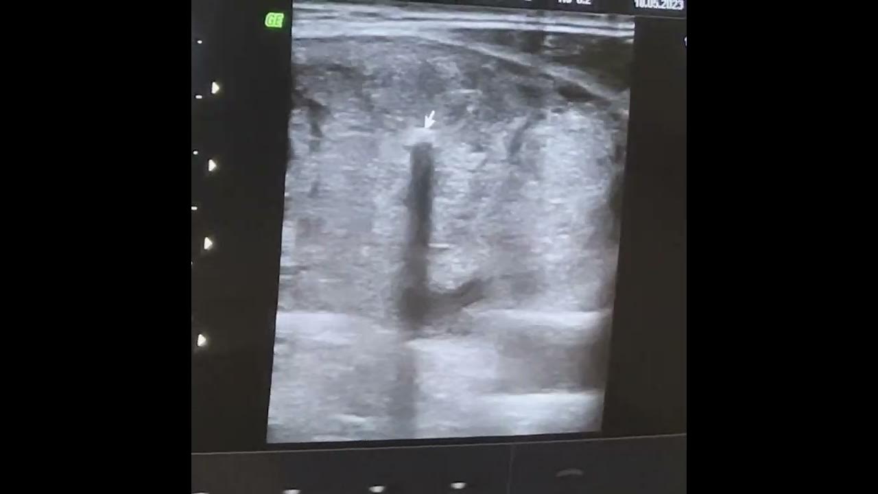 ti-rads-4-category-thyroid-nodule-ultrasound-case-youtube