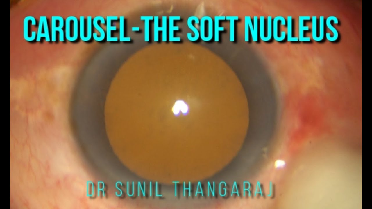 Carousel technique for the soft cataract - YouTube
