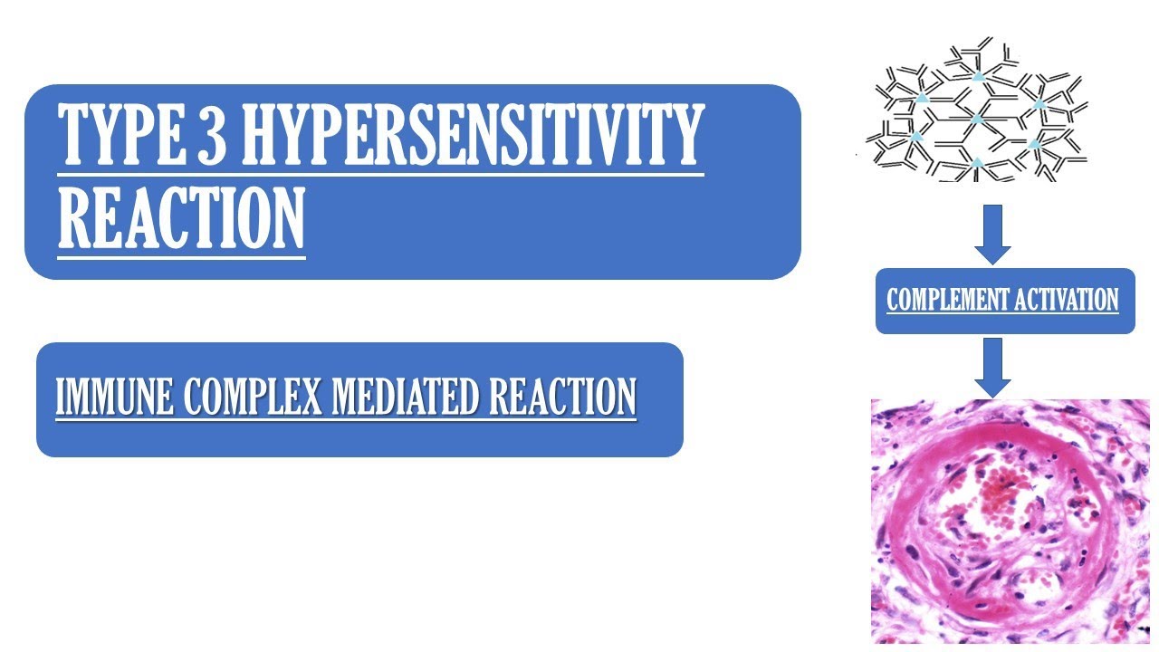 Type 03 Hypersensitivity Reaction | Made easy | Mechanism & Examples ...