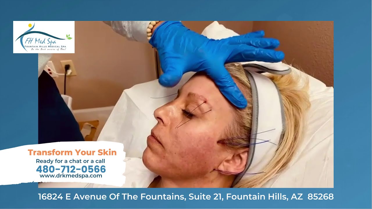 Eyebrow lift and Fox Eyes - PDO Thread Lift – Non-Surgical Facelift - YouTube