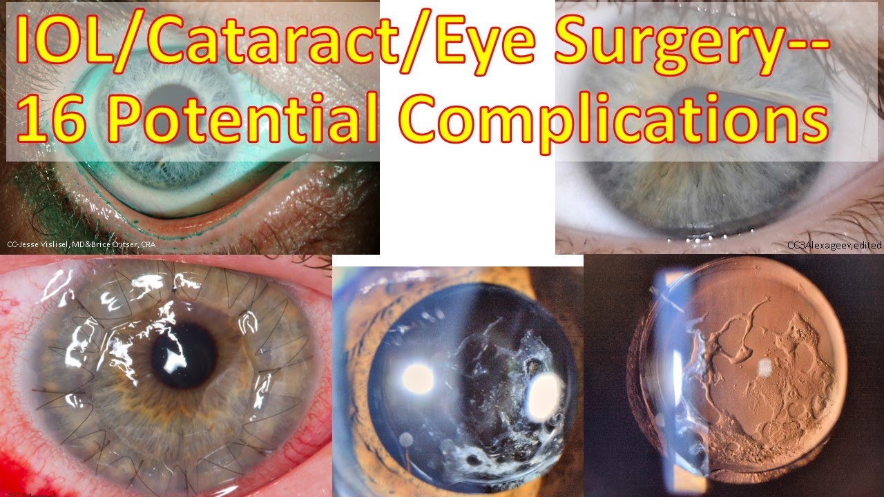 16 Things That Can Go Wrong: Cataract/Eye Surgery (4/4) - YouTube