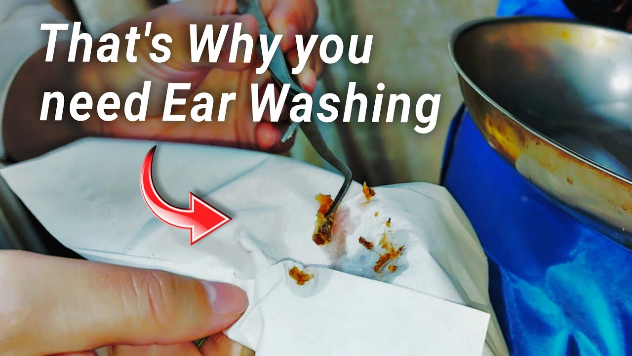 MESMERIZING Ear Wax Removal #earwaxremoval - YouTube