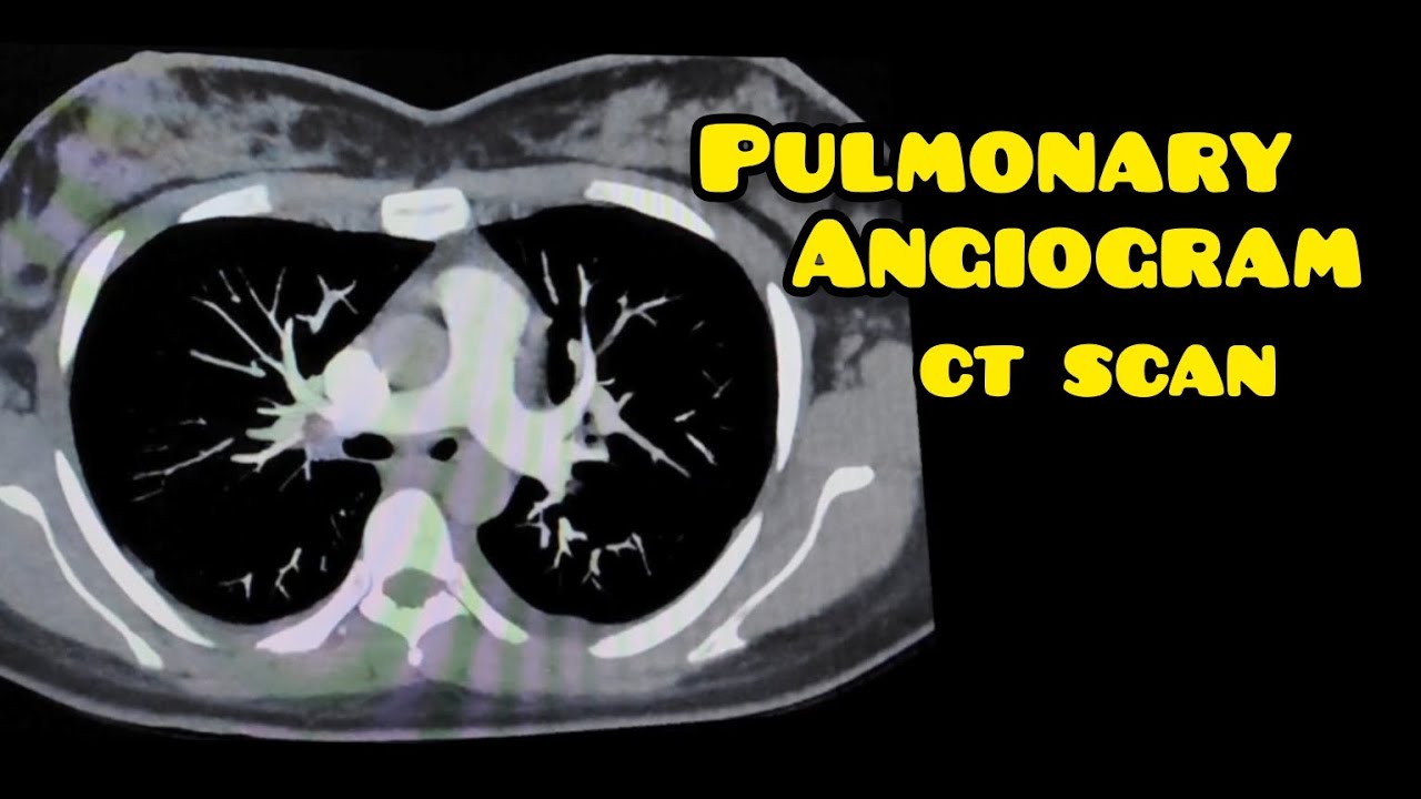 Pulmonary Angiogram CT Scan | Radiology | Cardiology - YouTube