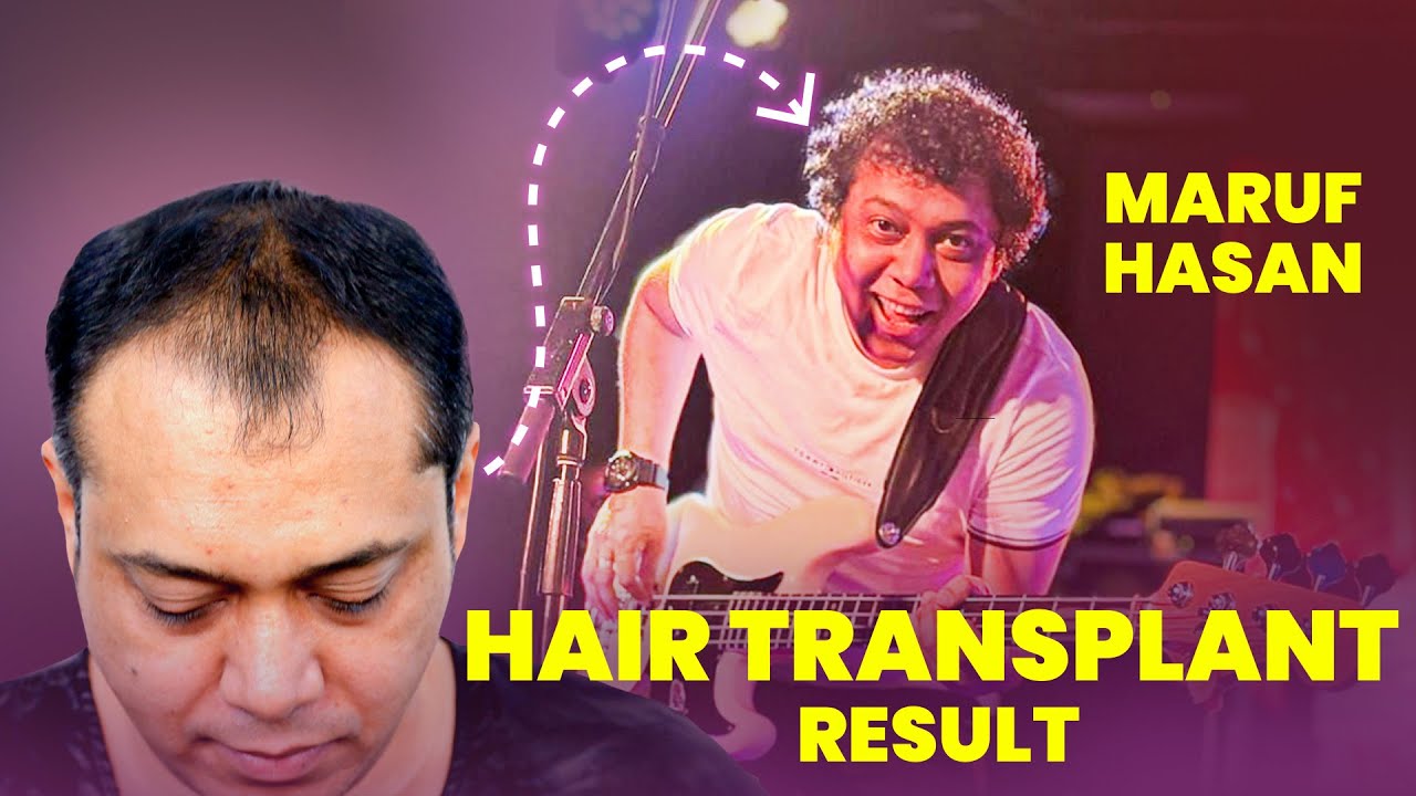 Guitarist "MARUF HASAN" Rocks a New Look 🔥 | Hair Transplant in ...