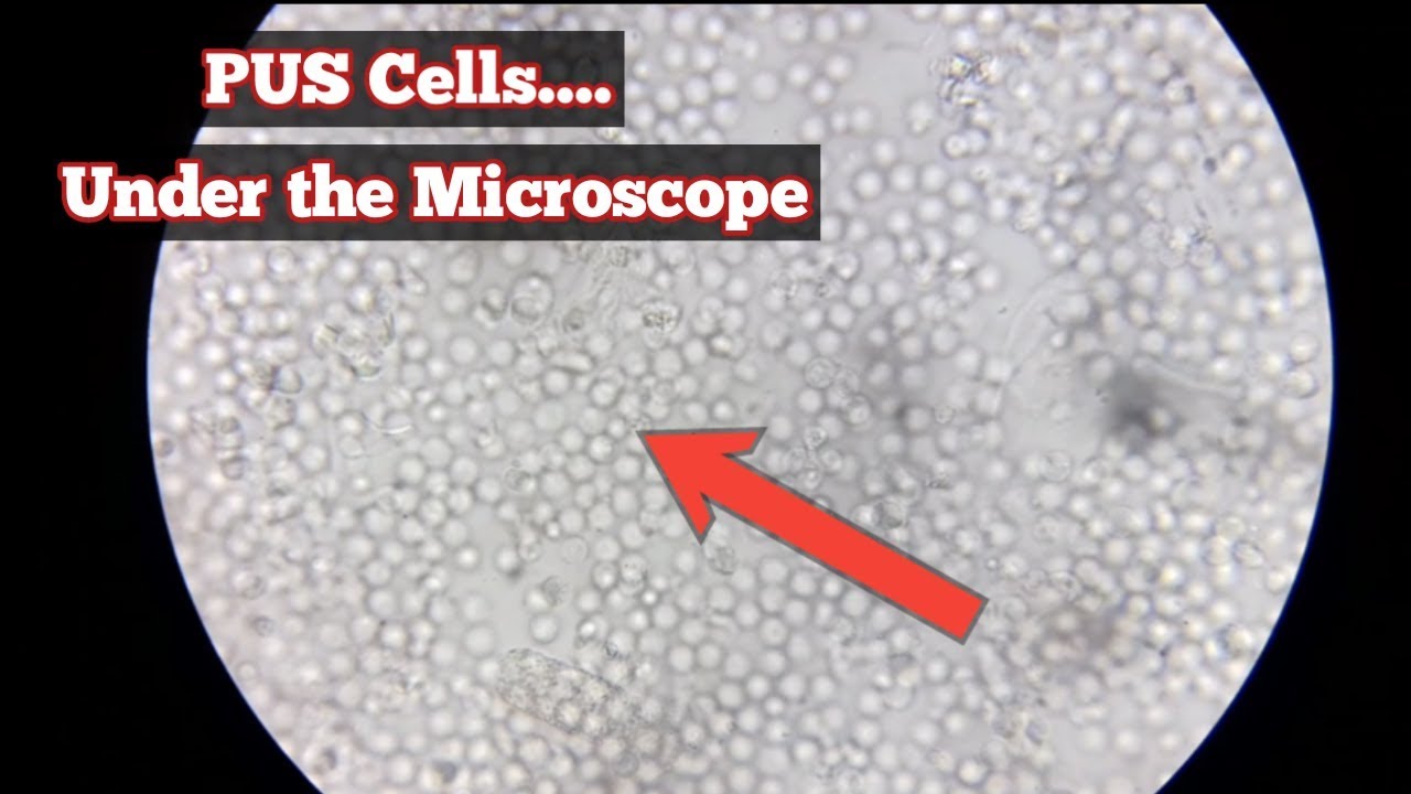 Zit Pus Under Microscope zit-pus-under-microscope