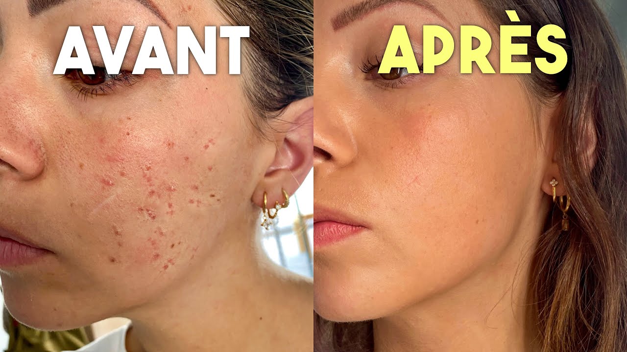 COMMENT JE ME SUIS DÉBARRASSÉE DES MICROKYSTES ! - YouTube