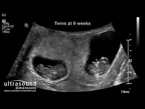 Scan of the Week: Twins at 9 weeks gestation!