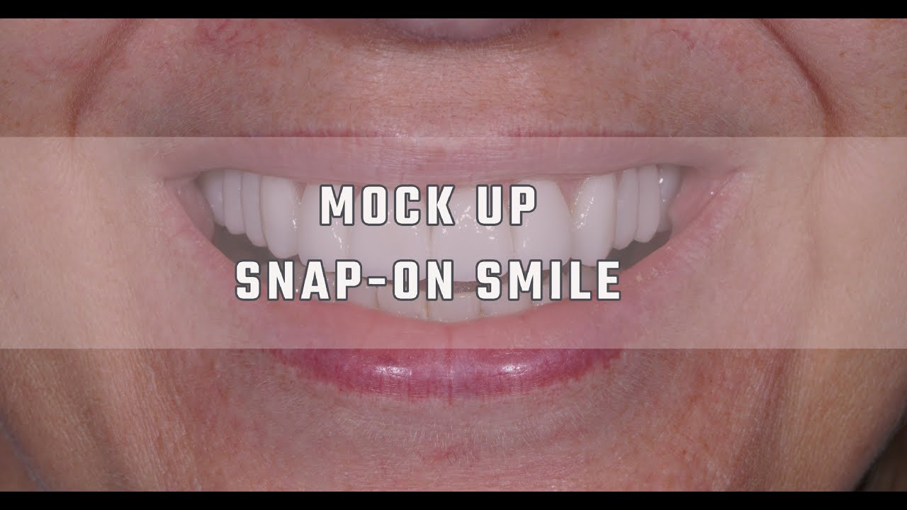 Mock up snap-on smile preview and Digital Smile Design - YouTube