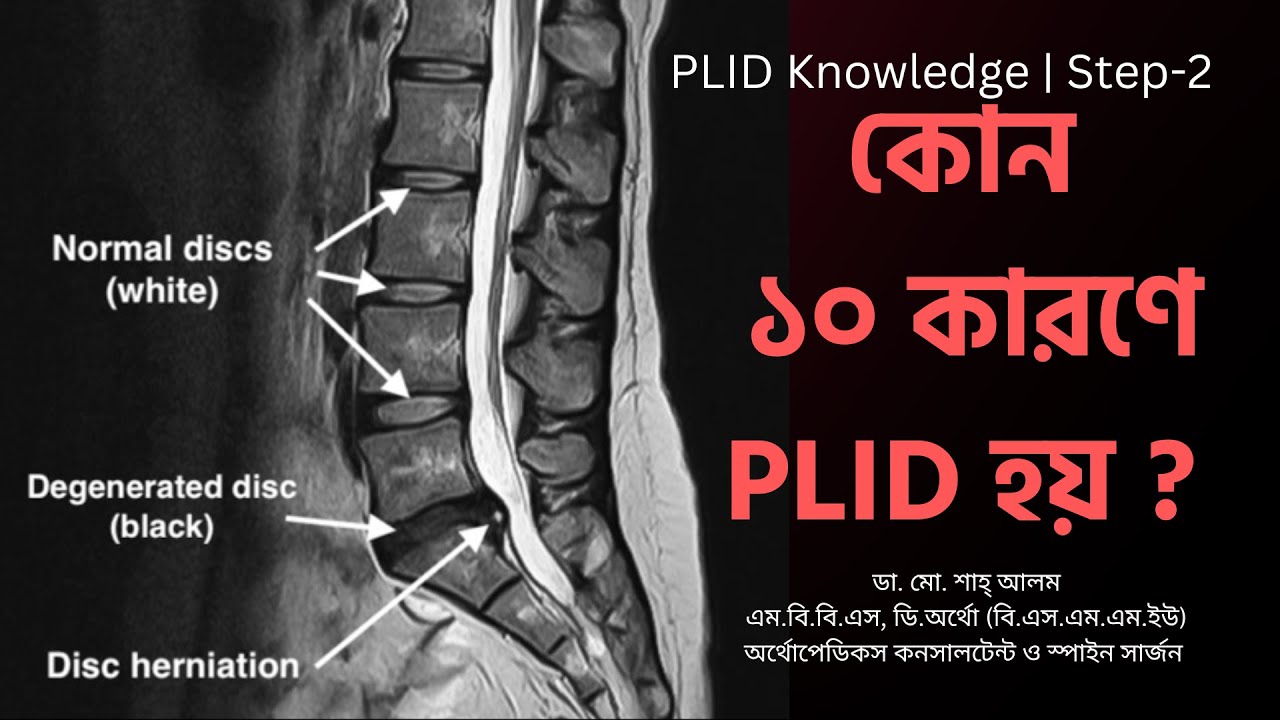 PLID 2 | কোন ১০ কারণে PLID হয় । Ten Causes Of PLID | Doctor Shah Alam ...