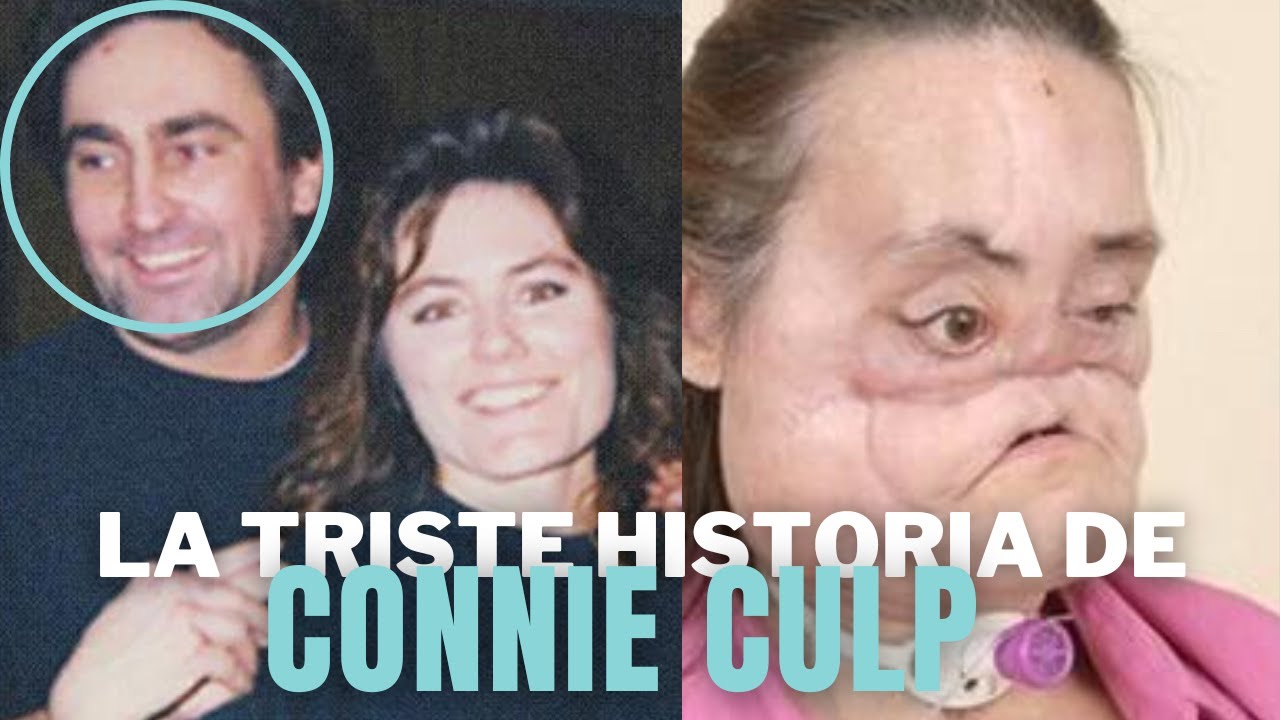La TRISTE historia de CONNIE CULP | Primer CASO de TRASPLANTE de cara ...
