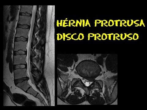 Ressonância Magnética: Hérnia discal protrusa - YouTube