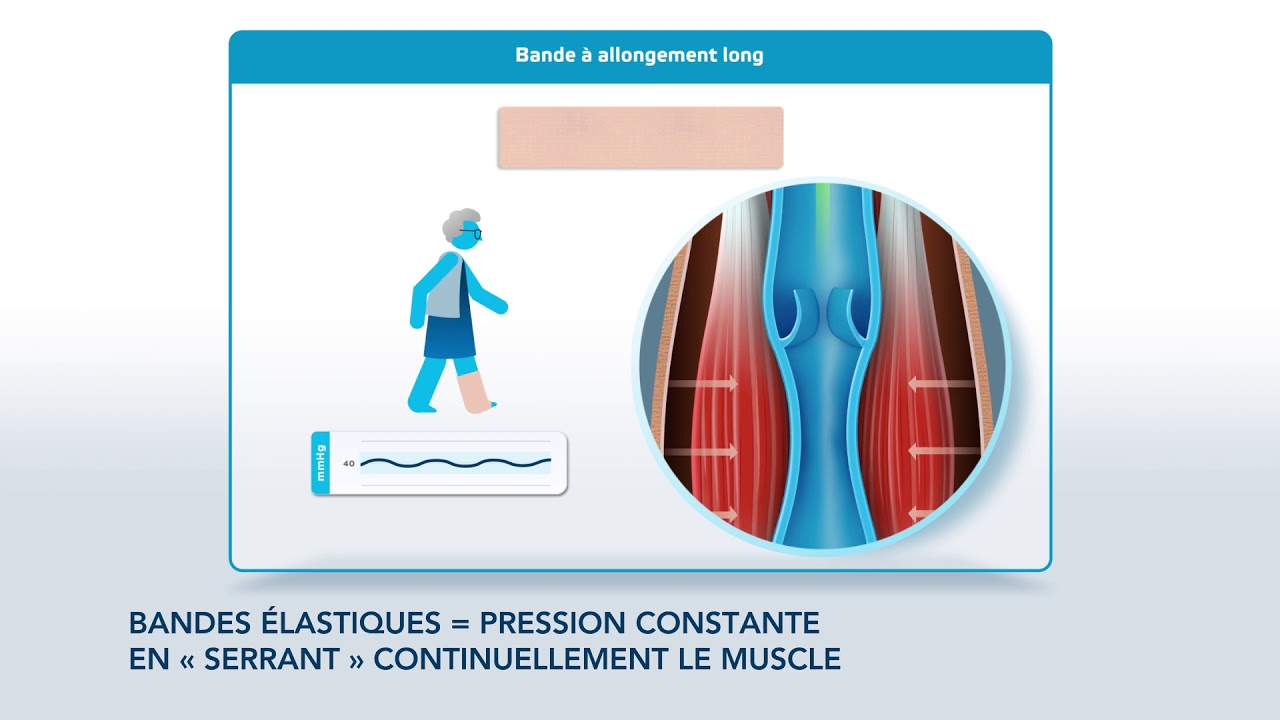 Comprendre la thérapie de compression pour ulcère veineux - Société ...