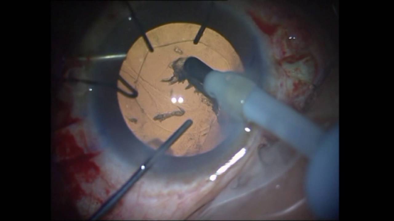 Supracapsular glued iol Soosan Jacob with audio 4mins video - YouTube