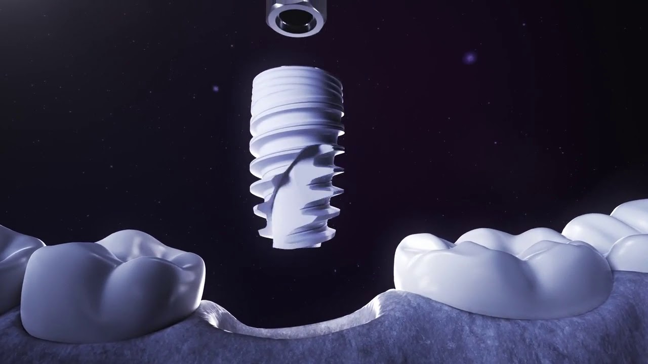 Nobel biocare FCZ - YouTube