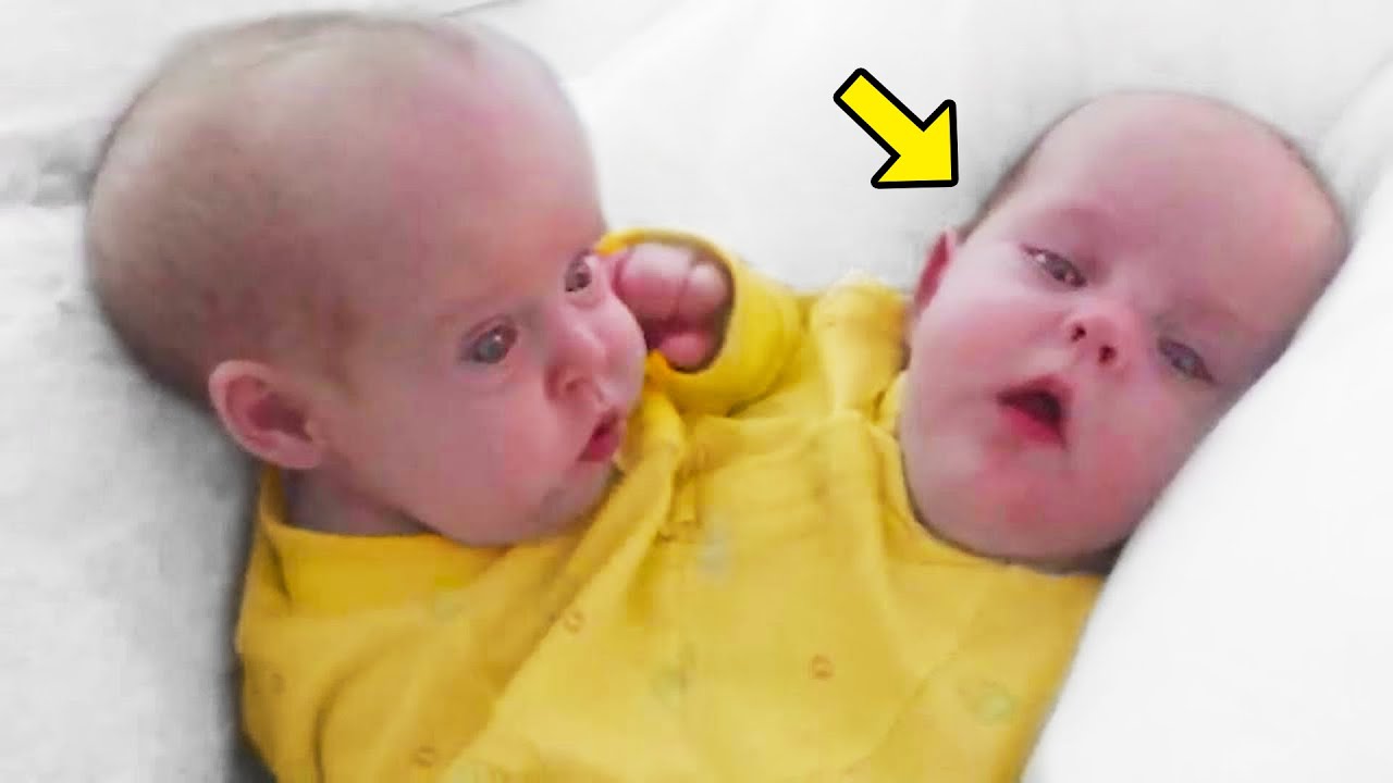 Remember These Conjoined Twins Separated 18 Years Ago? This Is What ...