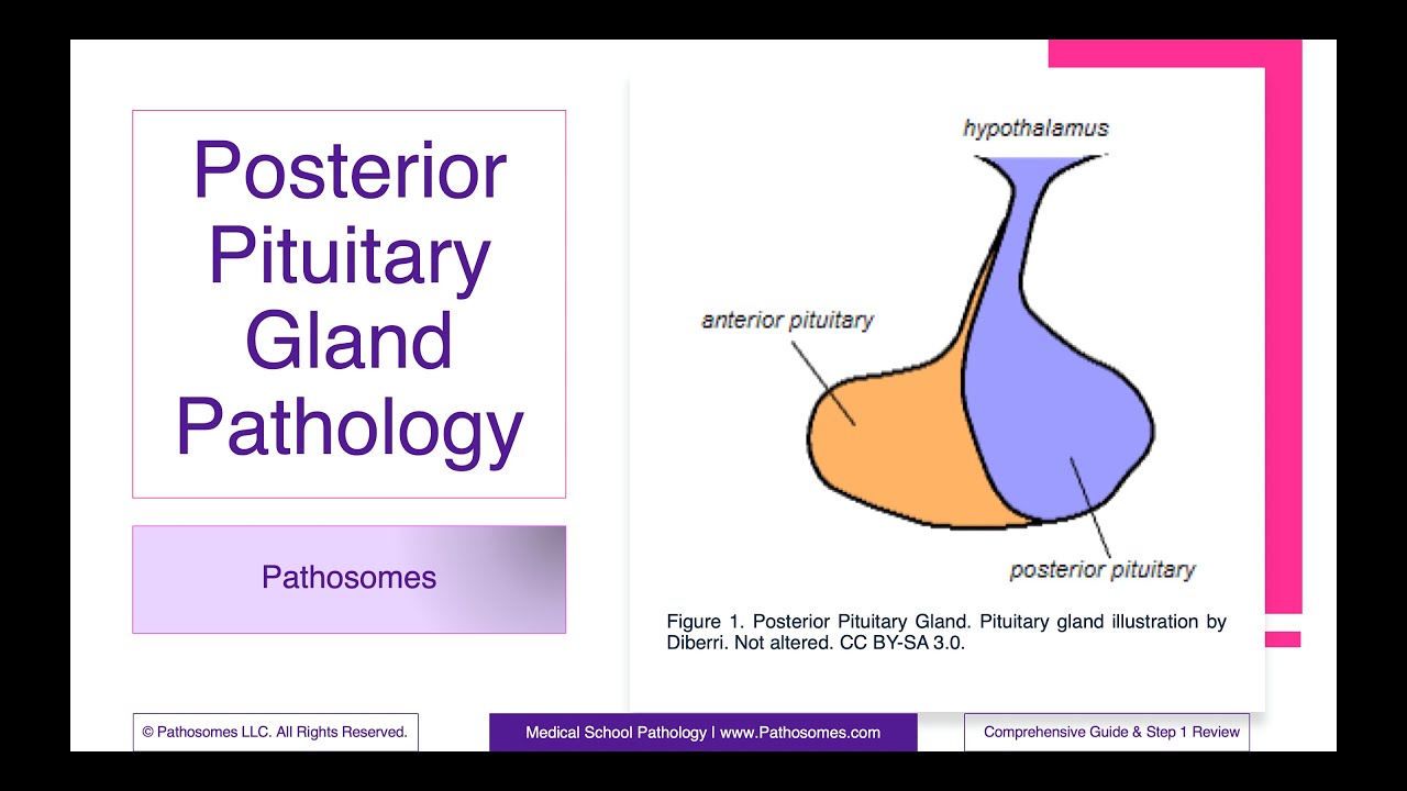 Posterior Pituitary Gland Pathology | Comprehensive Guide & Step 1 ...