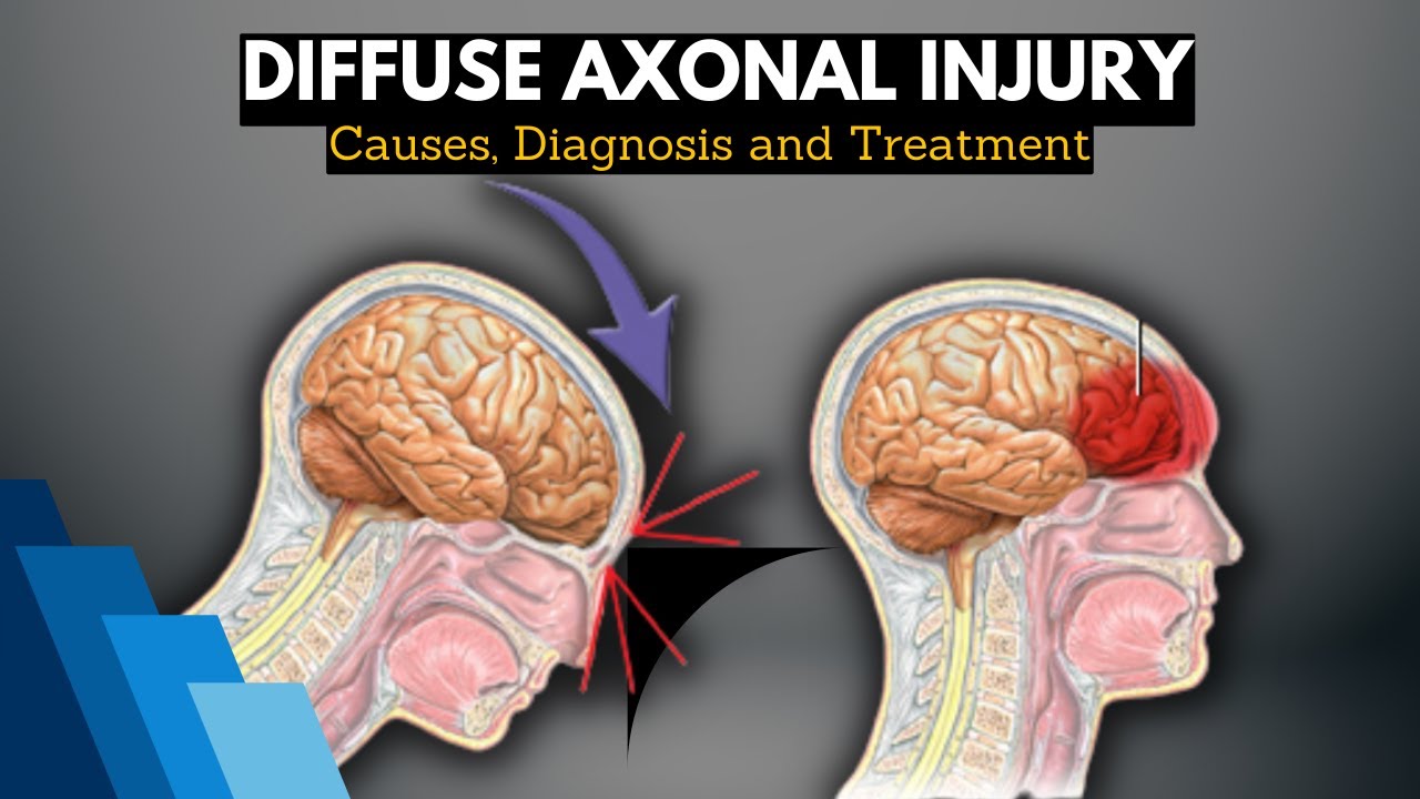 Diffuse Axonal Injury Causes Signs And Symptoms Diagnosis And diffuse-axonal-injury-causes-signs-and-symptoms-diagnosis-and