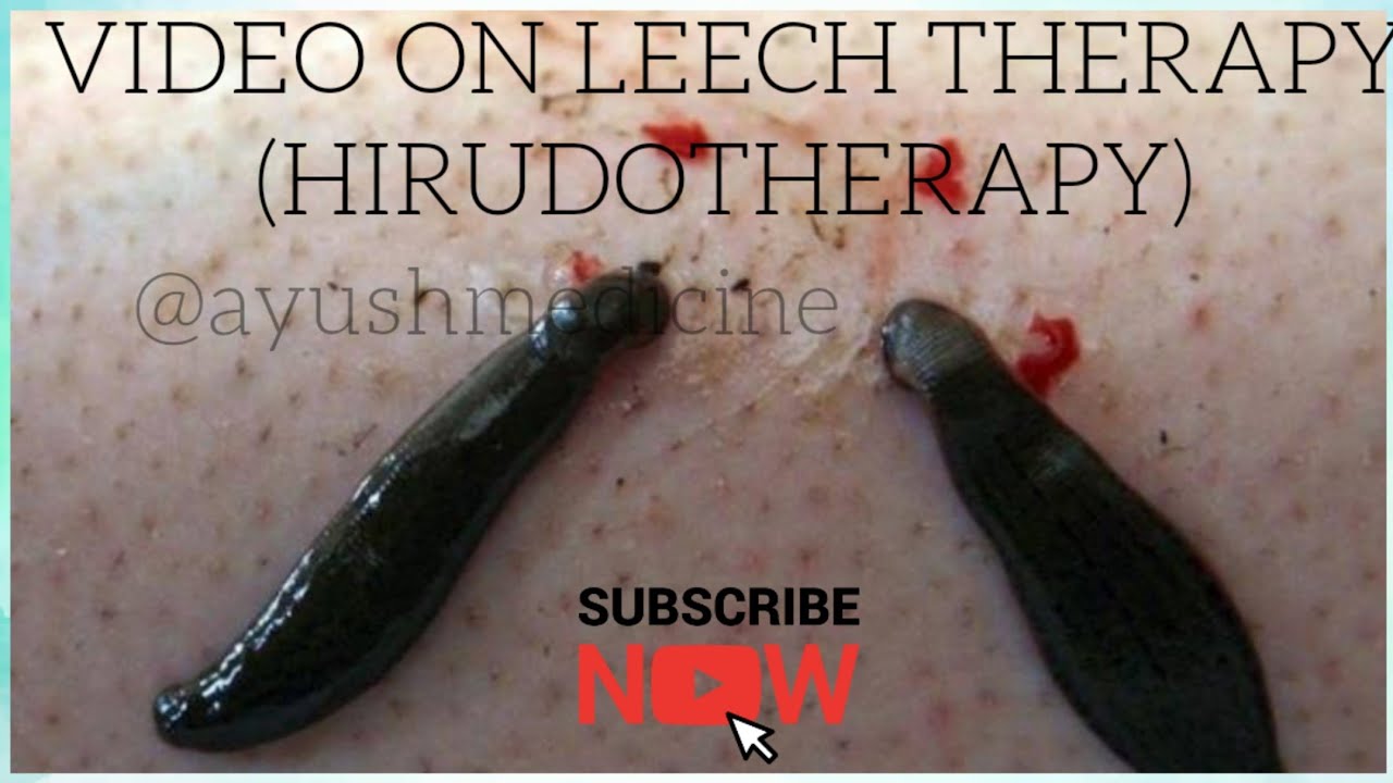 Video on leech therapy (HIRUDOTHERAPY) - YouTube