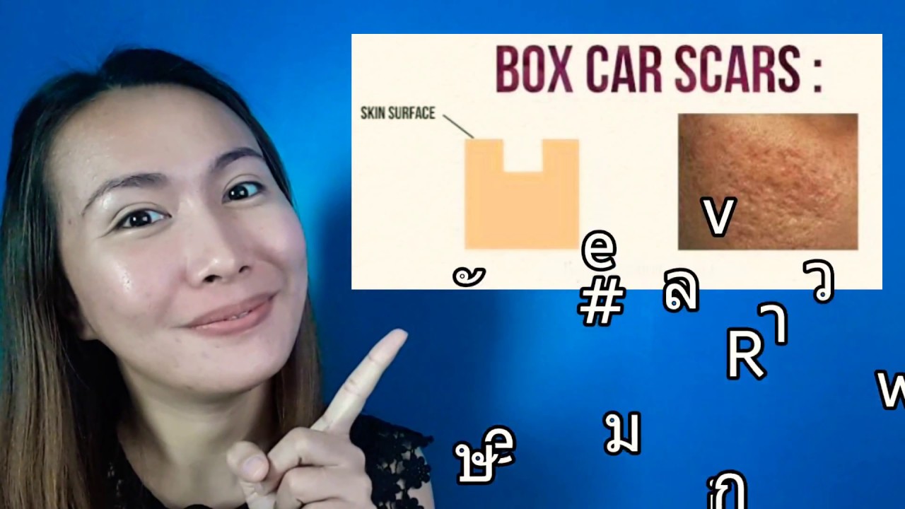 รีวิวการรักษาหลุมสิวแบบ Box Scar เคสคุณใหม่ - YouTube
