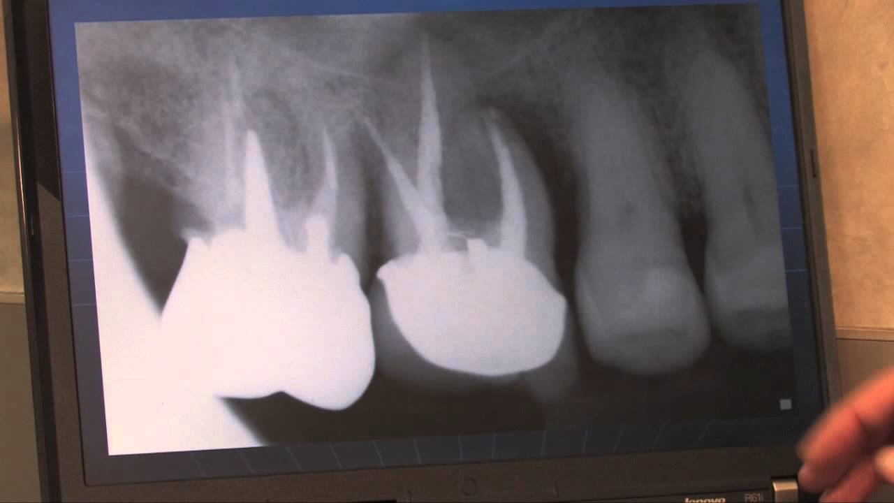 Classic Symptoms Of A Root Fracture 3 YouTube classic-symptoms-of-a-root-fracture-3-youtube