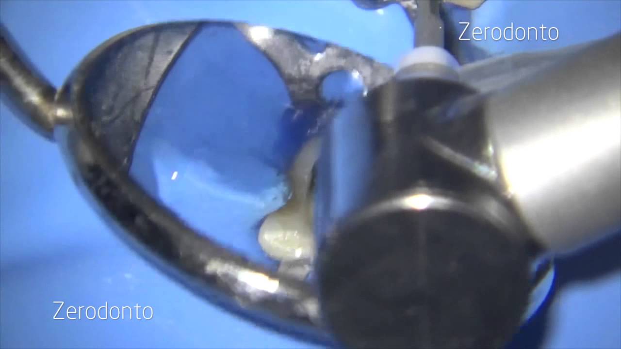 Dr. F. Bellucci | Dr. Z. Metzger | Self Adjusting File | Zerodonto ...