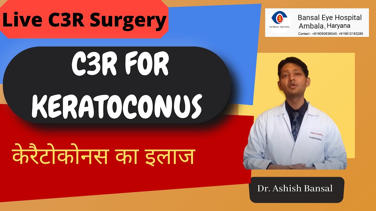 Live C3R Surgery | Keratoconus Treatment | केरैटोकोनस का इलाज | Corneal ...