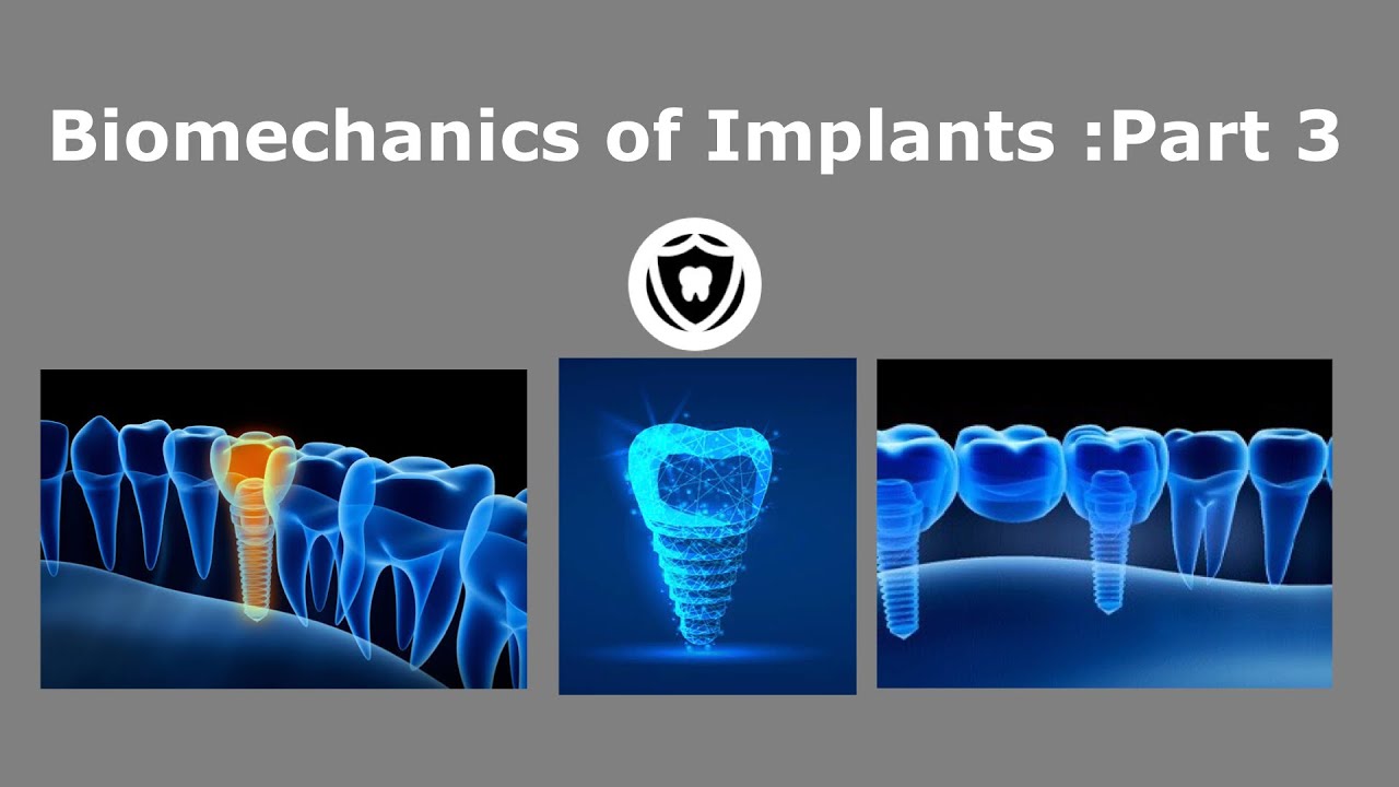 Biomechanics of dental implants Part 3 - YouTube