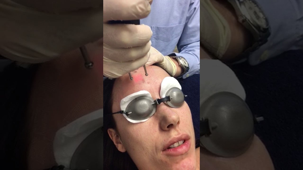 Erbium Yag Laser Treatment using Asclepion MCL31 Dermablate - YouTube